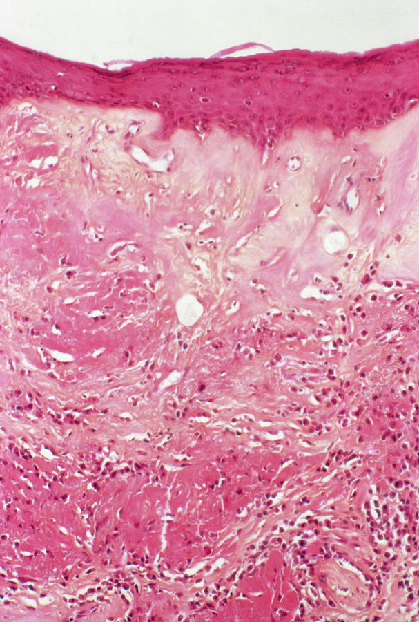 Dermatitis by Cnri / Science Photo Library