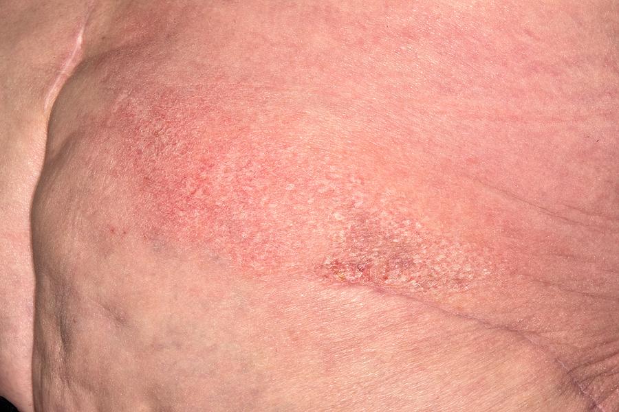 Dermatitis Following Shingles Infection Photograph By Dr P Marazzi