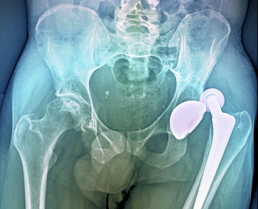 'dislocated Hip Replacement Photograph by Zephyr/science Photo Library ...