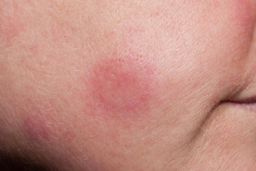 Drug Reaction Rash Photograph By Dr P Marazzi Science Photo Library
