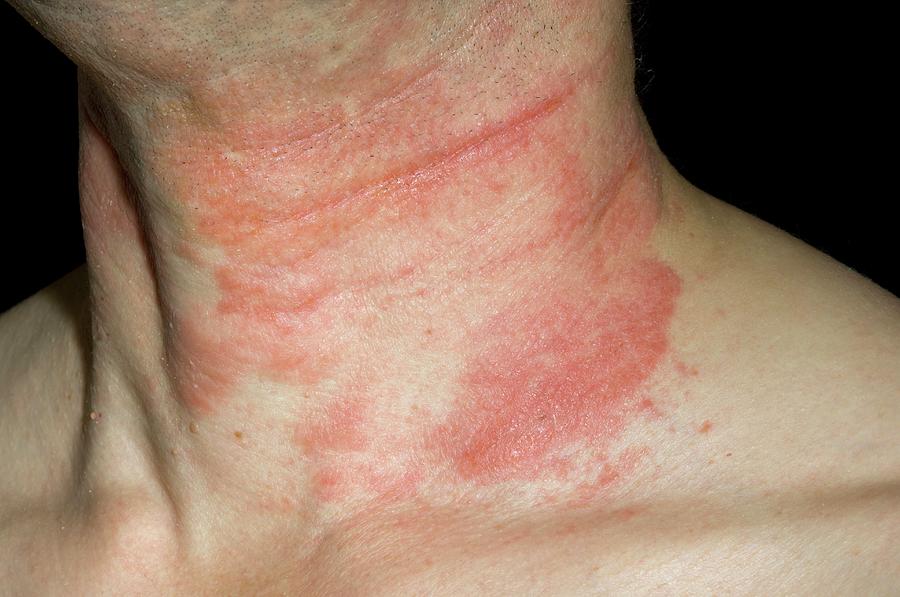 Eczema Rash On The Neck Photograph By Dr P Marazziscience Photo Library