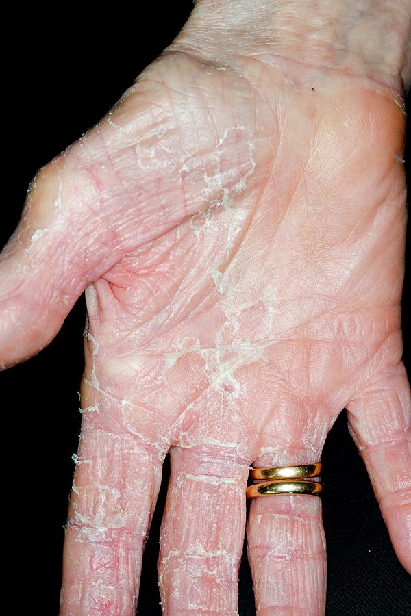 Exfoliative Dermatitis Of The Hand Photograph By Dr P Marazzi Science