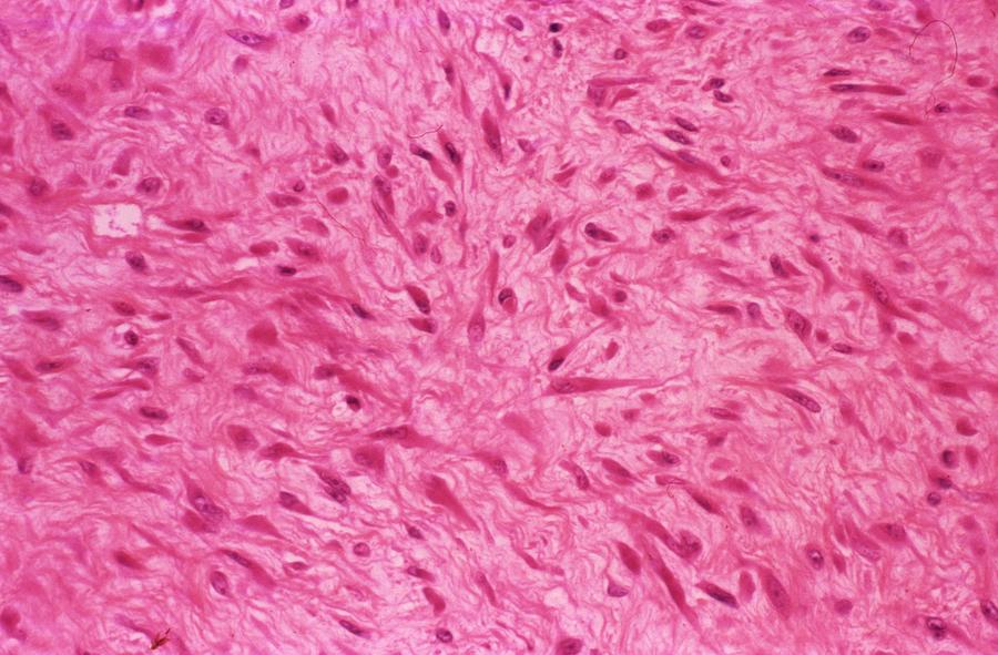 Fibrosarcoma by Science Photo Library