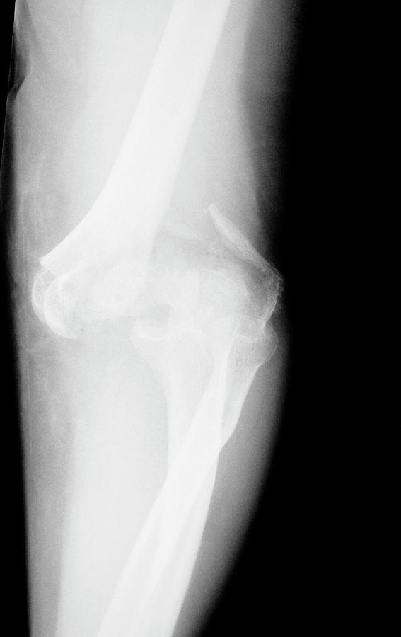 Fractured Elbow Photograph by Mike Devlin/science Photo Library - Fine ...