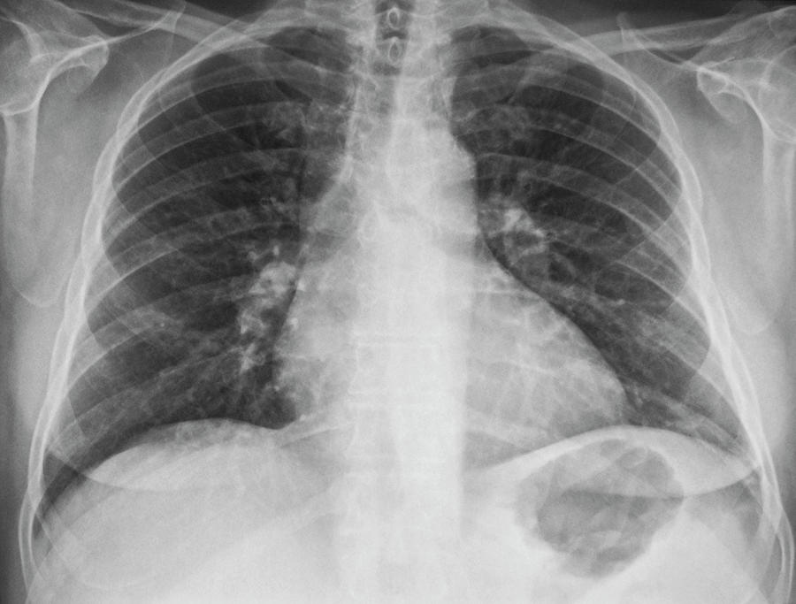 Heart Bypass Surgery Preparation Photograph By Antonia Reevescience