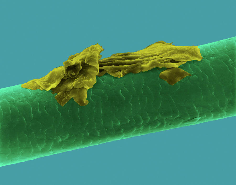 Human Hair With Dandruff Photograph by Dennis Kunkel Microscopy/science ...