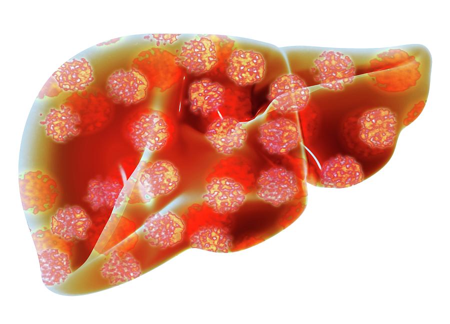 Human Liver With Hepatitis Viruses Photograph by Alfred Pasieka - Fine ... Human Liver With Hepatitis Viruses Photograph by Alfred Pasieka - Fine ...