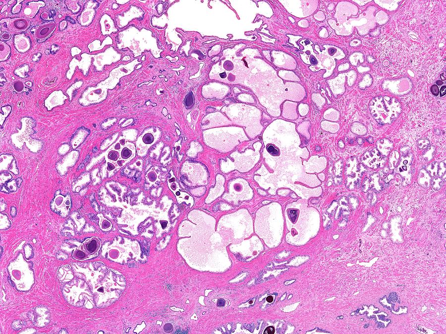 Human Prostate Photograph by Microscape - Fine Art America