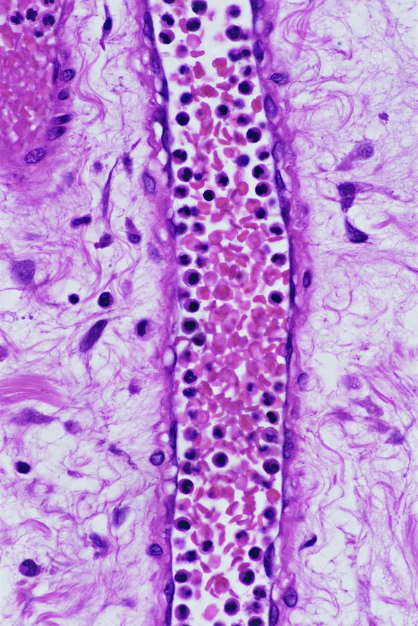 Inflammatory Response Photograph by Microscape/science Photo Library ...