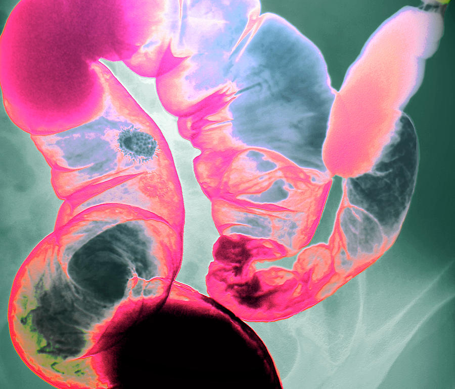 Intestinal Parasite Photograph by Science Photo Library - Pixels