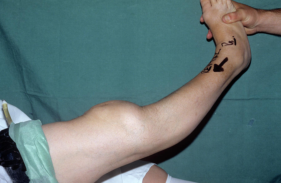 Knee Joint Laxity Photograph by Mike Devlin/science Photo Library - Pixels