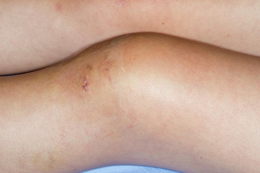 Knee Swelling After Surgery Photograph By Dr P Marazziscience Photo Library
