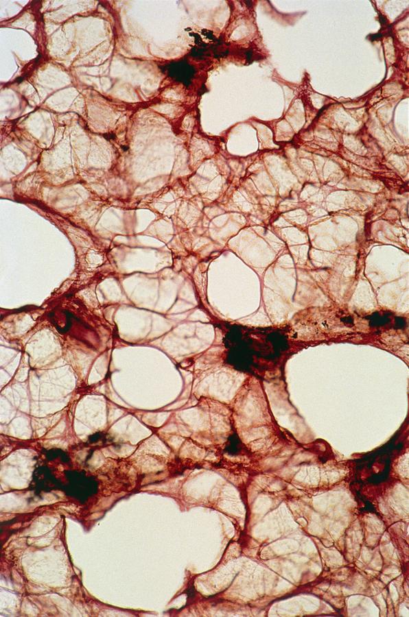 Light Micrograph Of Coal Dust In The Lung. Photograph by Astrid & Hanns-frieder Michler/science ...