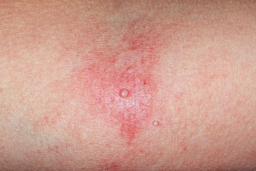 Molluscum Contagiosum And Eczema Photograph By Dr P Marazzi