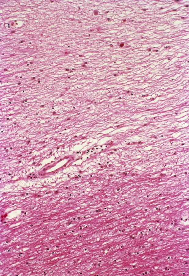 Multiple sclerosis, light micrograph by Science Photo Library