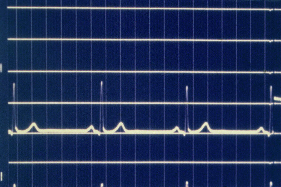 Normal Ecg Pattern Photograph by Science Photo Library. - Pixels