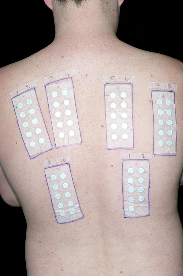 Patch Testing For Allergies Photograph by Dr P. Marazzi/science Photo ...