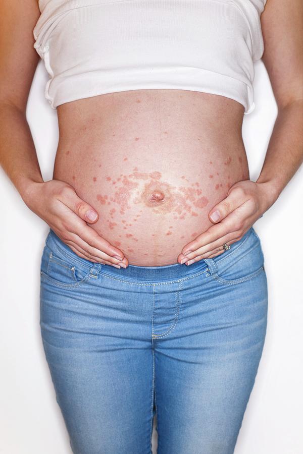 Pregnant Woman With Rash On Tummy Photograph By Ian Hooton Science