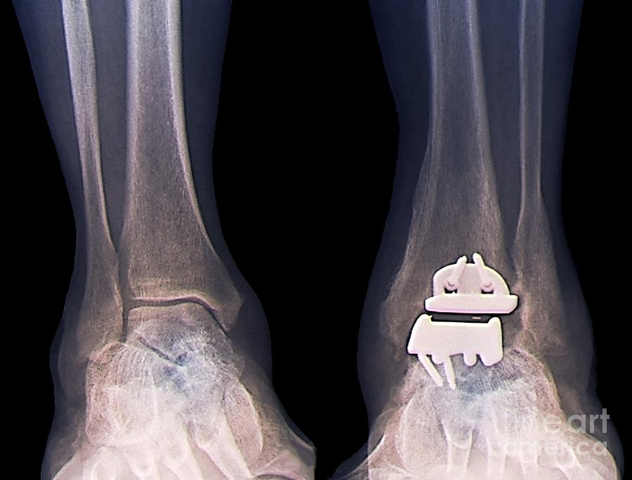 Replacement Ankle Joint, X-ray by Science Photo Library