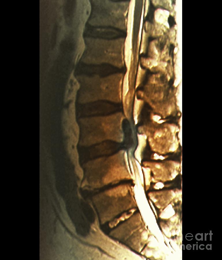 Sciatica, Mri Scan by Science Photo Library
