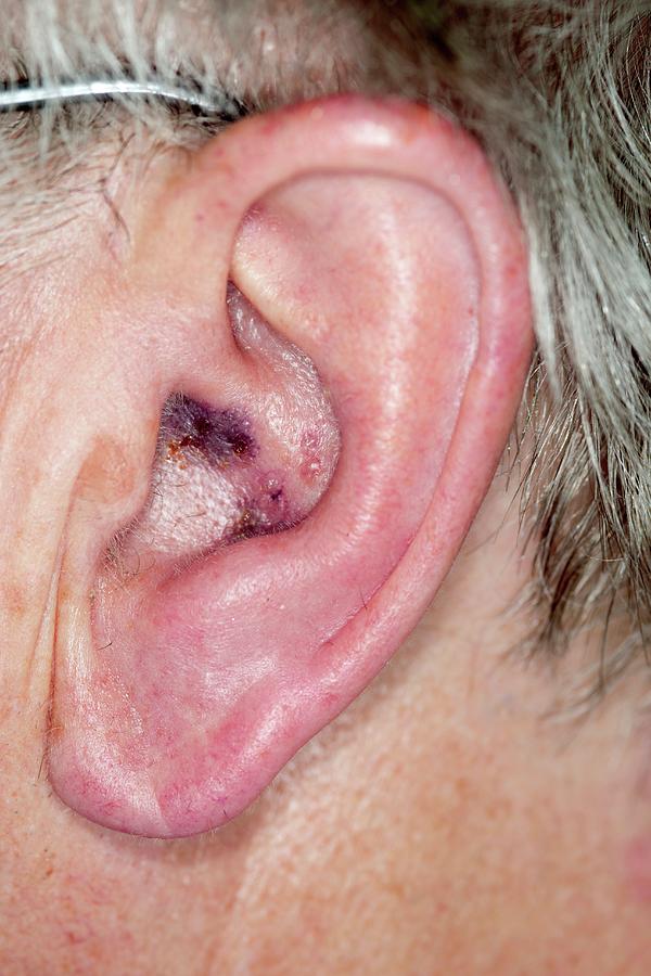 Shingles In The Ear Photograph By Dr P Marazziscience Photo Library