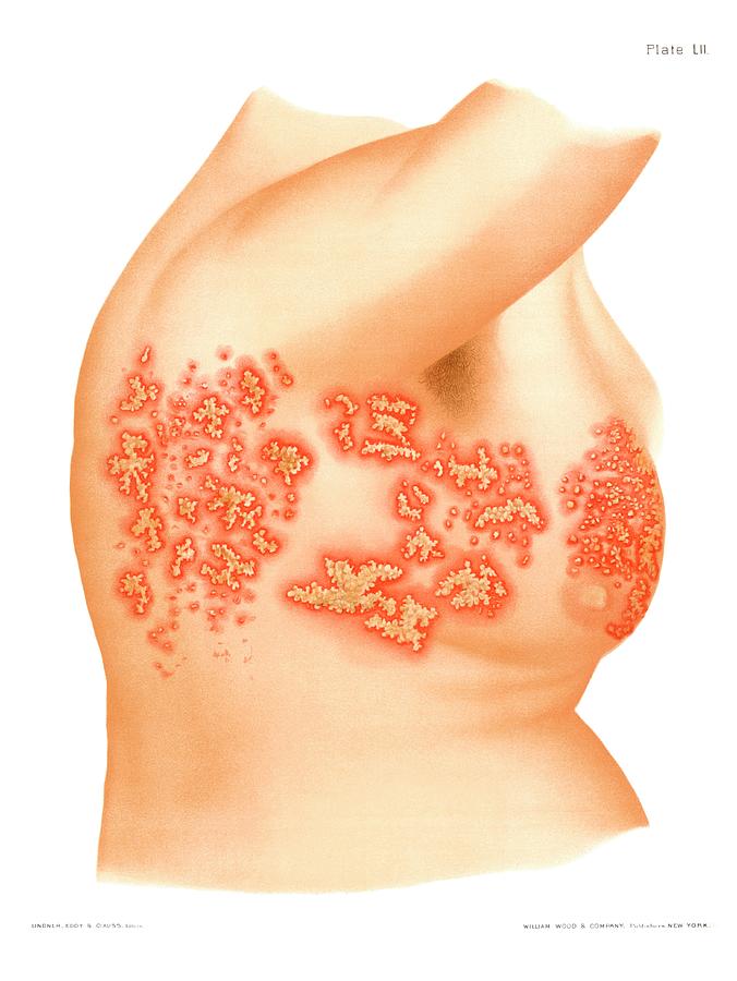 Shingles Rash Photograph By Us National Library Of Medicinescience Photo Library