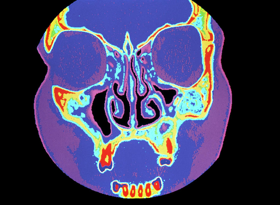 Sinusitis by Cnri / Science Photo Library