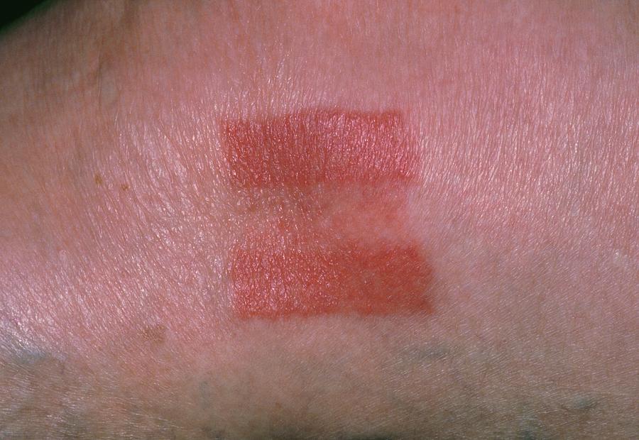Skin Rash Caused By Allergy To Elastoplast Photograph by Dr P. Marazzi ...
