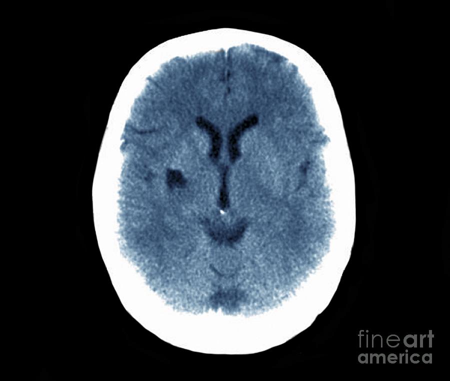 Stroke, Ct Scan by Zephyr / Science Photo Library