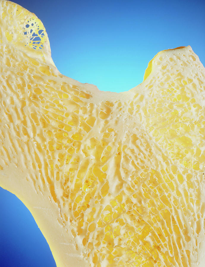 Thigh Bone Head Photograph by Astrid & Hanns-frieder Michler/science Photo Library - Fine Art ...