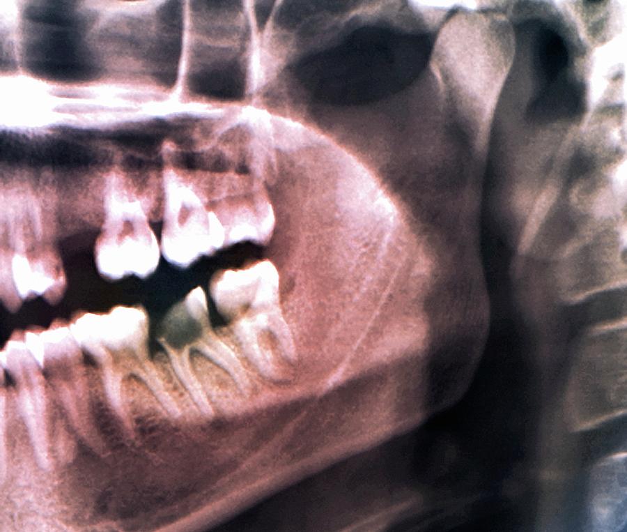 Tooth Decay by Science Photo Library