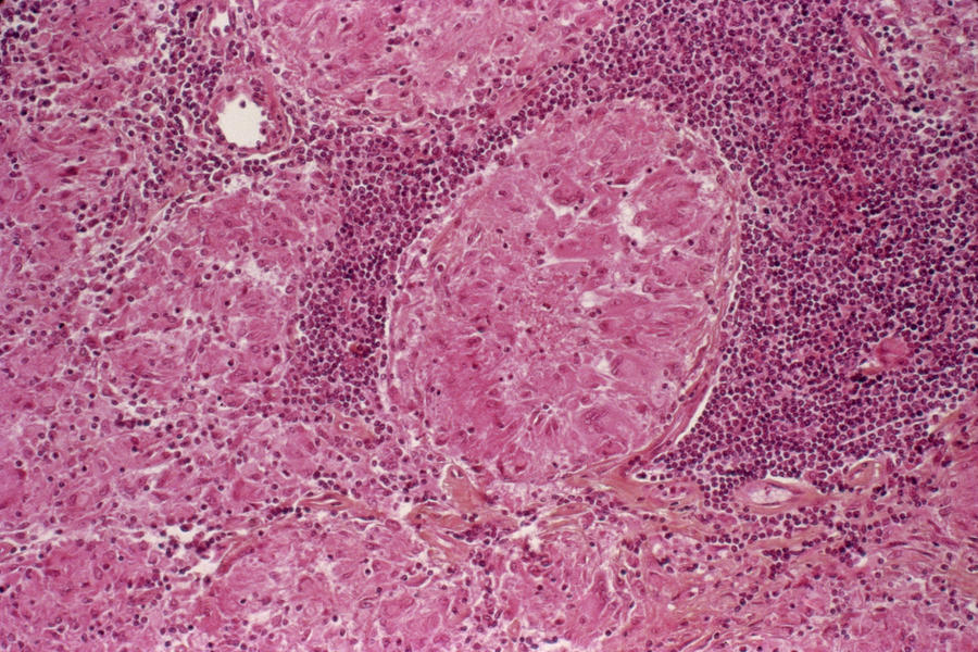 Tuberculosis by Science Photo Library