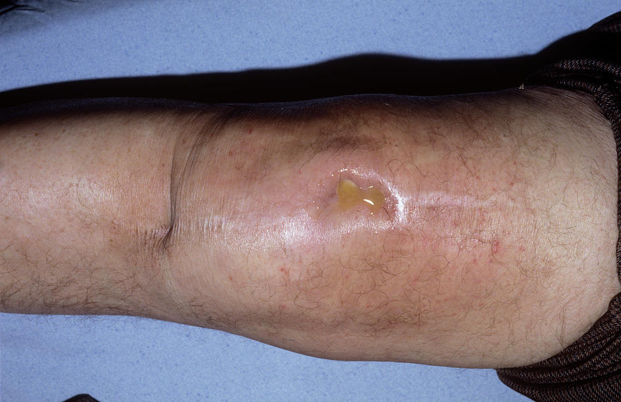 Wound Sinus by Science Photo Library