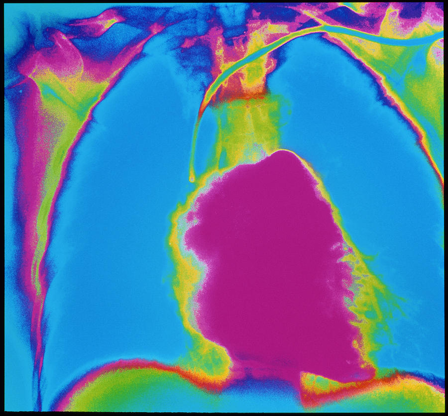 X-ray Of Heart Photograph by Mehau Kulyk/science Photo Library | Fine ...