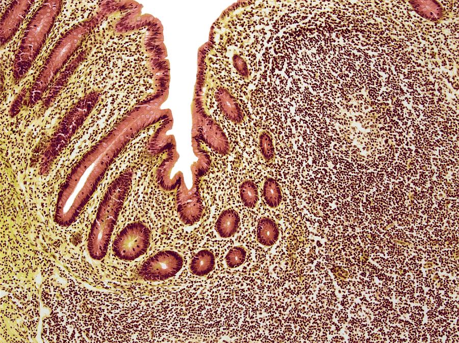 Appendicitis, Light Micrograph #1 by Science Photo Library