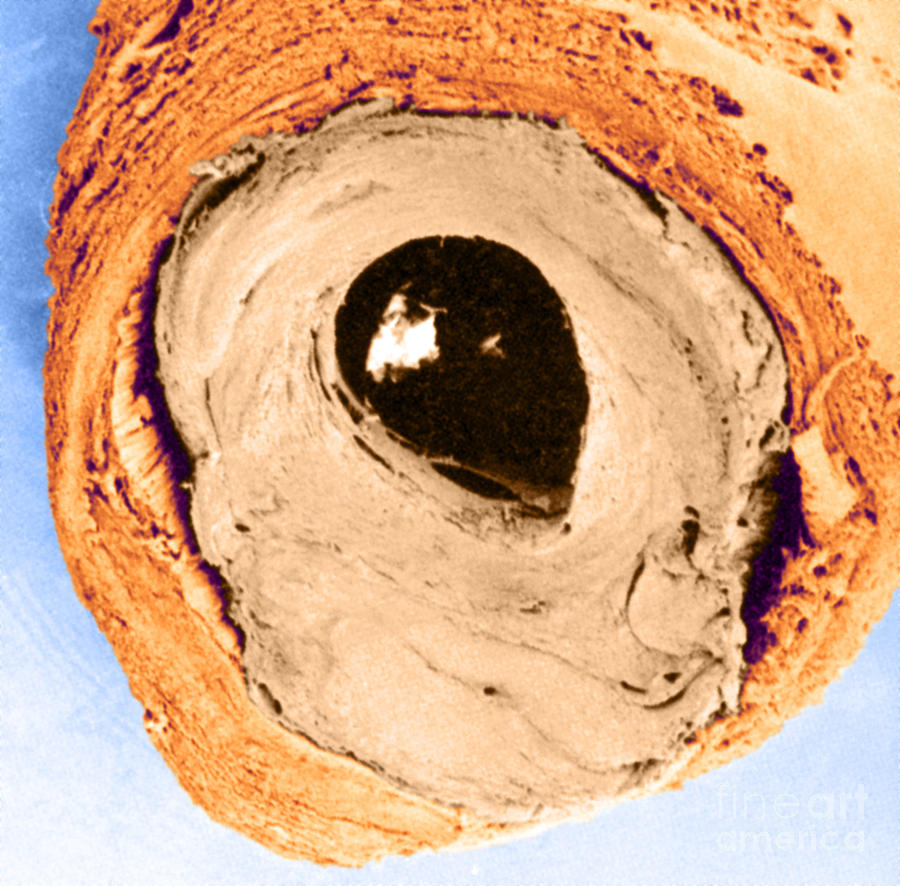 Atherosclerosis Sem, Partial Blockage Photograph by Science Source ...