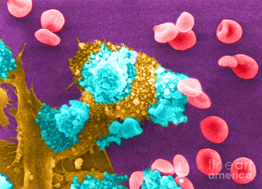 Cancer Cell Death Sem 3 Of 6 Photograph By Science Source Fine Art