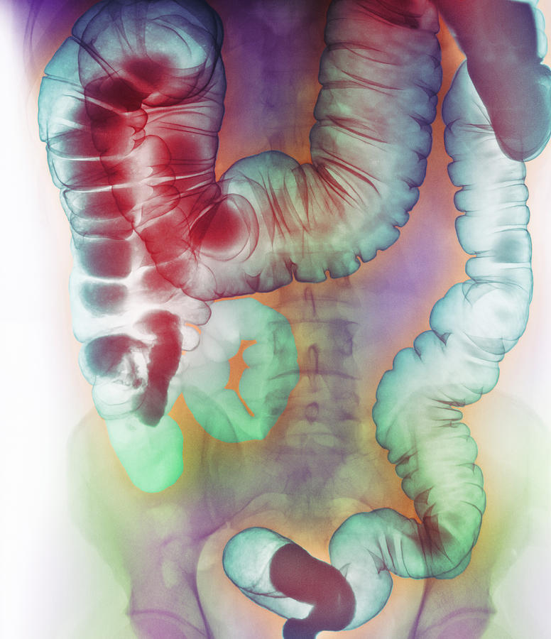 Coloured X-ray Of The Abdomen Showing Proctitis #1 by Science Photo Library
