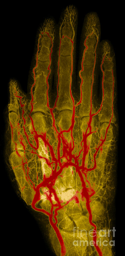 Hand Arteriogram Photograph by Science Source