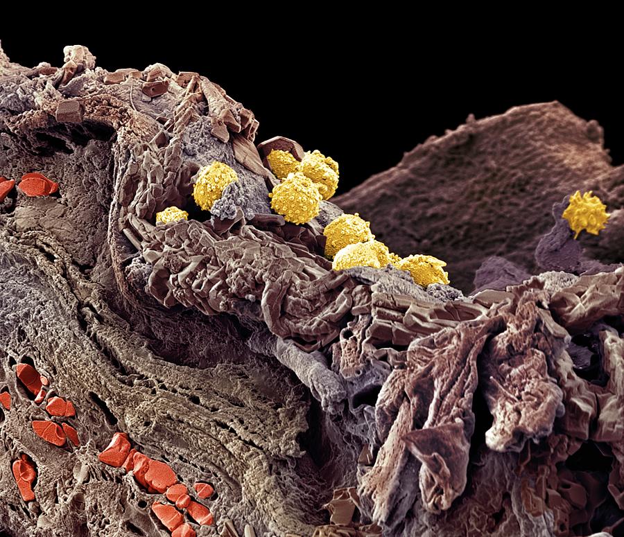 Pyoderma Skin Disease, Sem Photograph by Steve Gschmeissner - Pixels