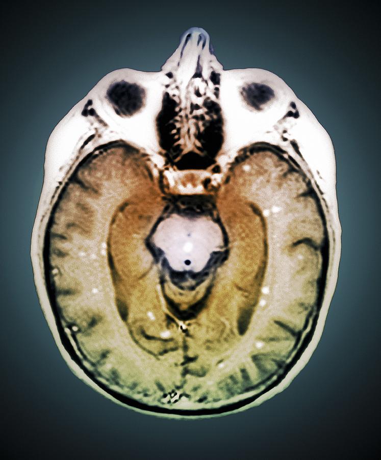Secondary Brain Cancer Mri Scan Photograph By Zephyr Pixels