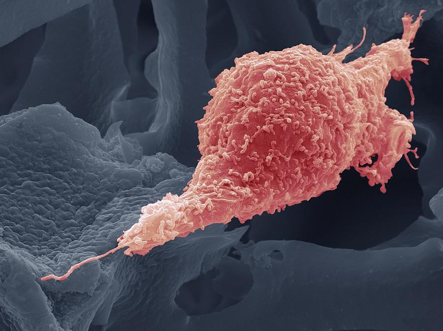 Cervical Cancer Cell Sem Photograph By Steve Gschmeissner Pixels