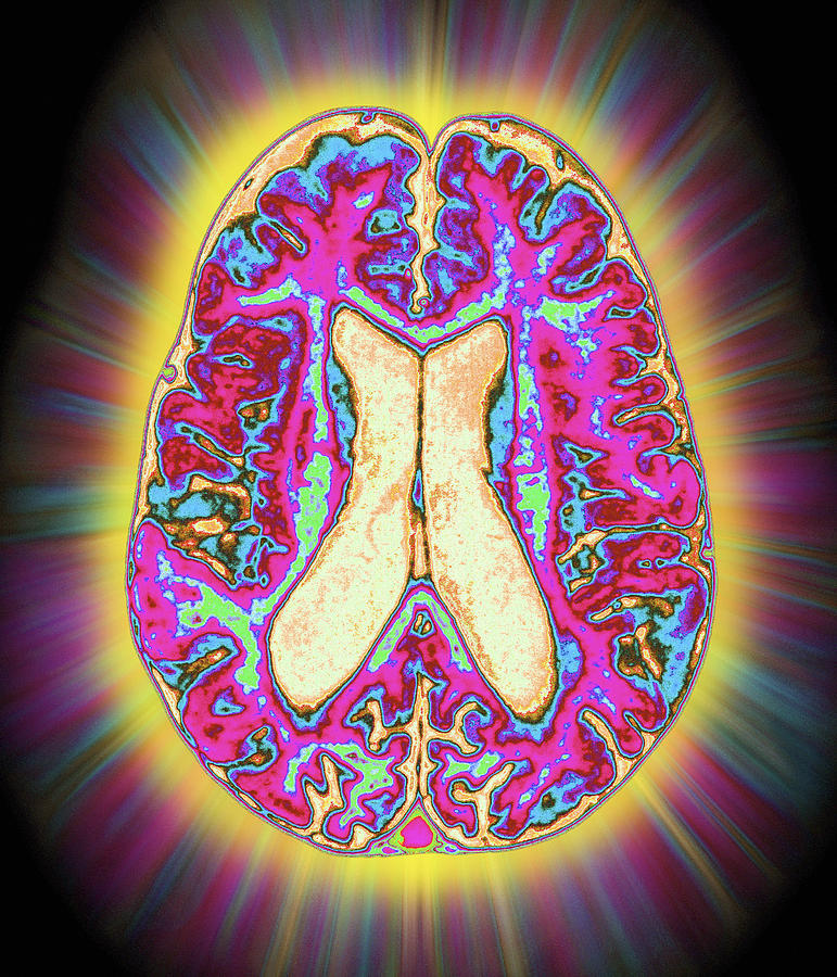 Coloured Mri Scan Of Organophosphate Brain Damage #2 by Science Photo Library