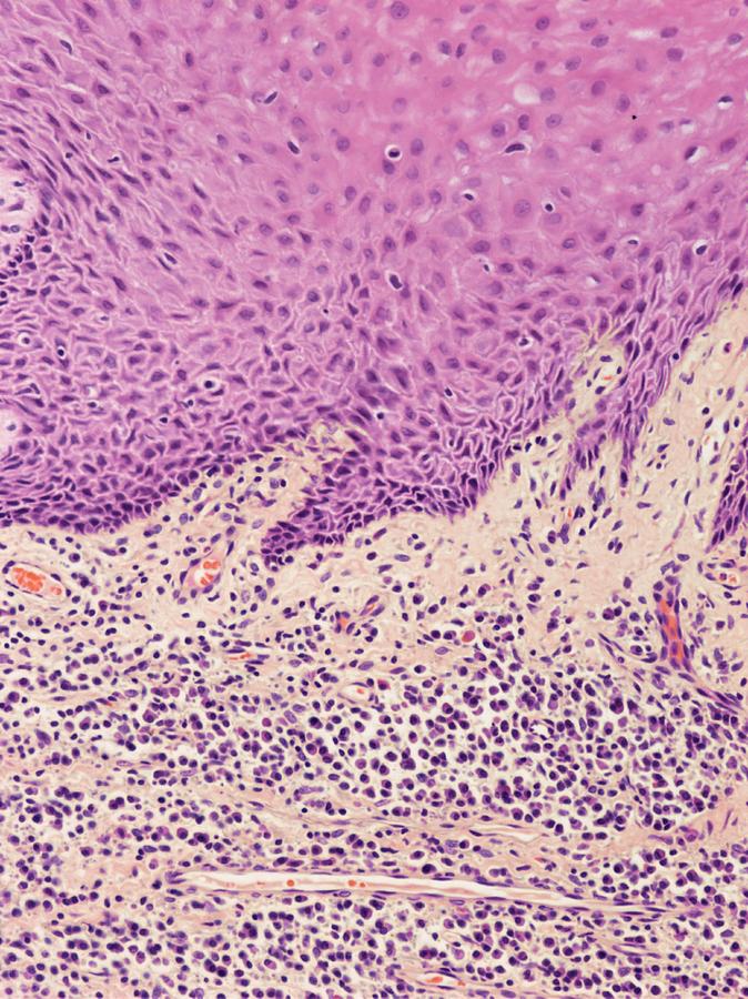 Gingivitis, Light Micrograph #2 by Science Photo Library