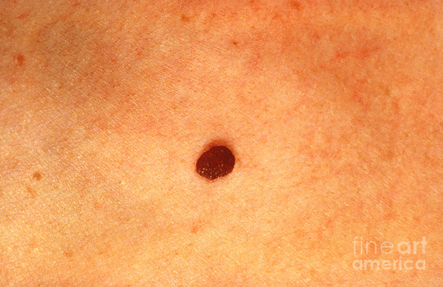 Normal Mole Photograph by Science Source | Pixels