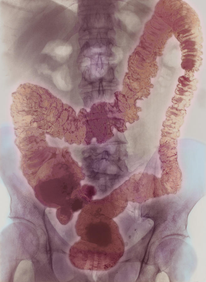 Ulcerative Colitis X-ray #2 by Cnri / Science Photo Library