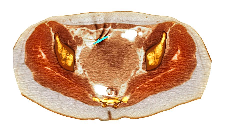 Ectopic Iud Contraceptive Ct Scan Photograph By Du Cane Medical