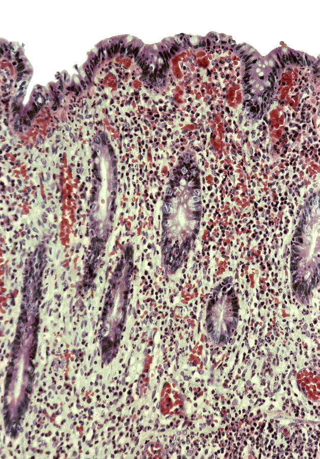 Appendicitis, Light Micrograph by Science Photo Library