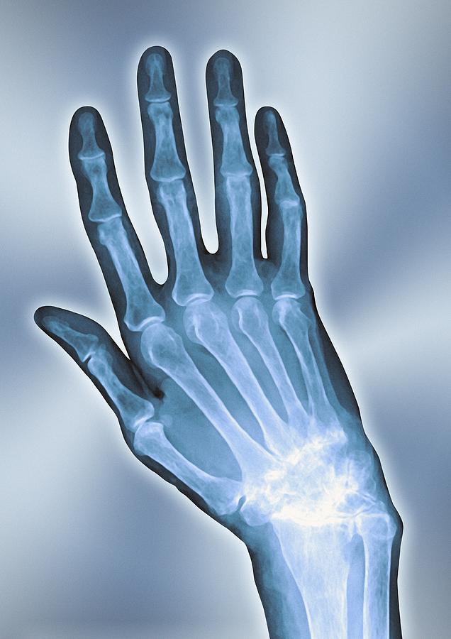 Arthritic Hand, X-ray Photograph by Miriam Maslo - Fine Art America