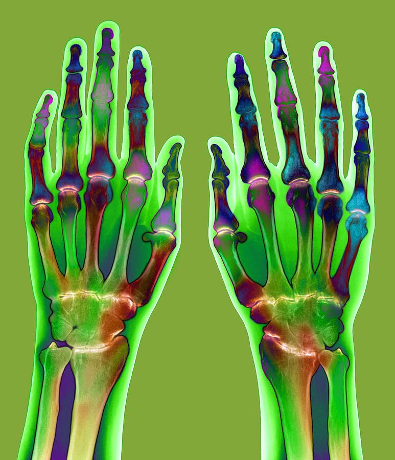 Arthritic Hands, X-ray Photograph by Du Cane Medical Imaging Ltd - Fine ...